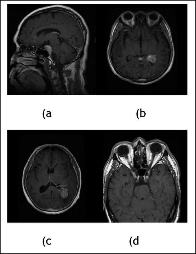 Classification and Detection of Brain Tumor Images Using Deep Learning | Springer Nature Link