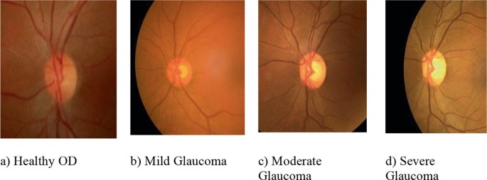 A Hybrid DCNN-Gradient Boosting Approach for Glaucoma Severity Stage Detection with Instance ...