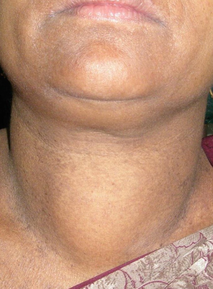 Acute Neck Swelling | SpringerLink