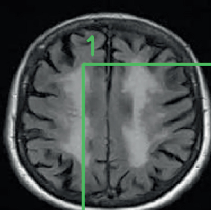 Enhanced Brain Tumor Detection Using Convolutional Neural Networks and ...