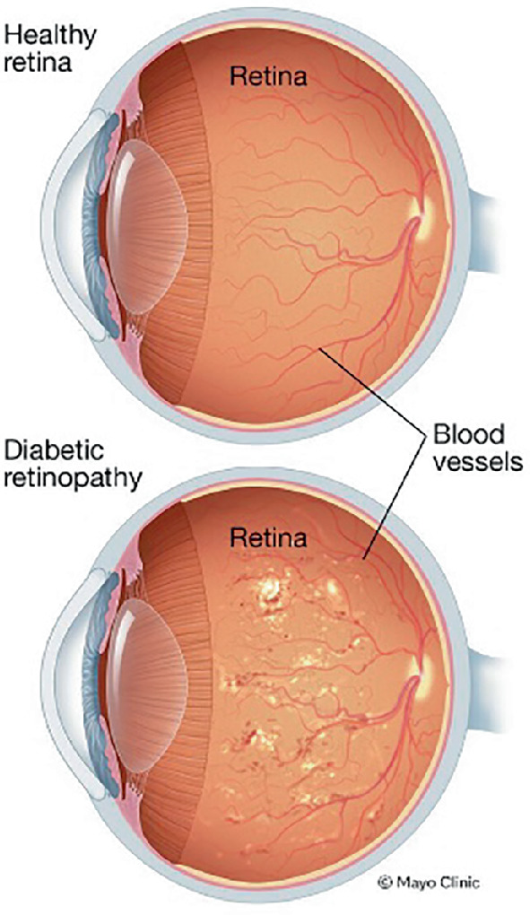 Automatic Diabetic Retinopathy Identification Based on Deep Learning ...