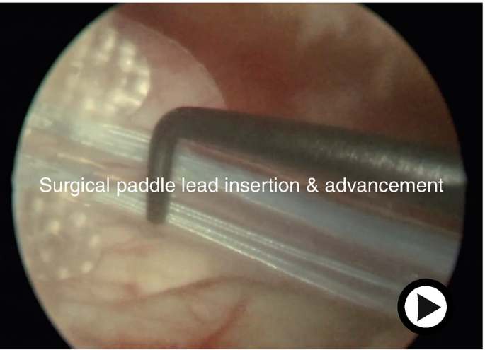 Technique of Spinal Cord Stimulation by Unilateral Biportal Endoscopic ...