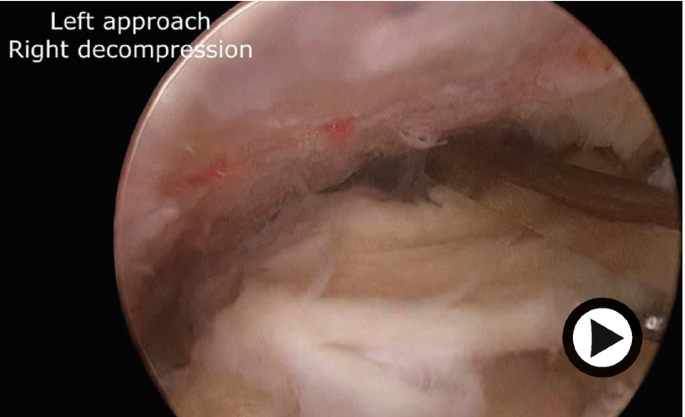 Biportal Endoscopic Bilateral-Contralateral Decompression | SpringerLink