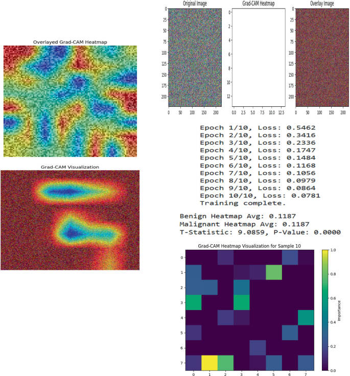 Breast Cancer Detection with Enhanced Interpretability Using VGGNet-19 ...