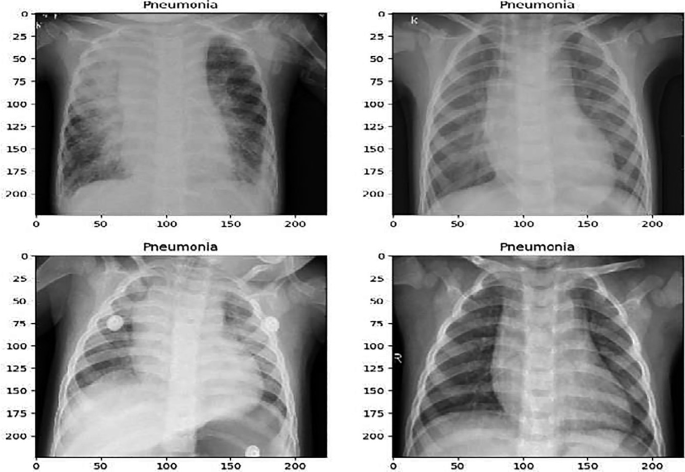 Enhancing Pneumonia and COPD Detection Through Deep Learning: A ...