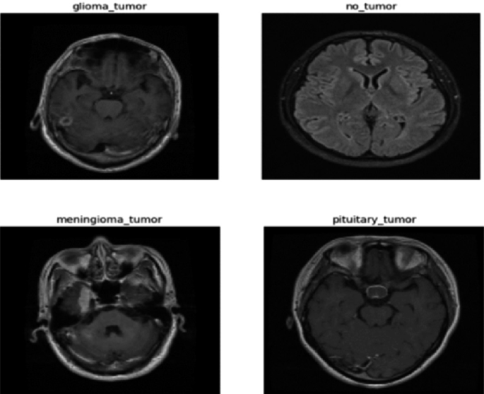 Enhanced CNN Model Techniques for Classification of Brain Tumor and ...