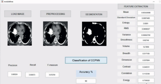 Automated Detection of Lung Cancer Using Deep Learning Models on CT ...