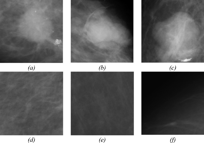 Enhanced Breast Cancer Diagnosis from Mammogram Images with Deep ...