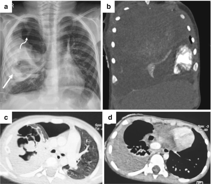 Pulmonary, Pleural, and Chest Wall Masses | SpringerLink