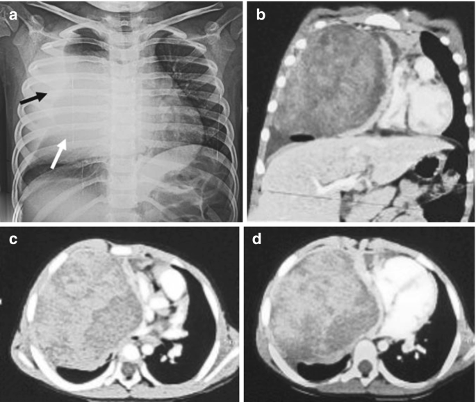Pulmonary, Pleural, and Chest Wall Masses | SpringerLink