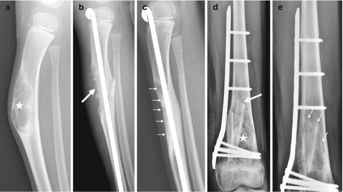 Bone Tumors | SpringerLink