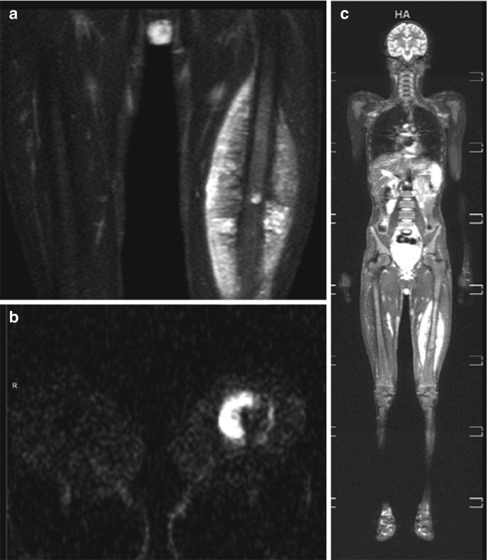 Whole-Body MRI in Pediatric Oncology | SpringerLink