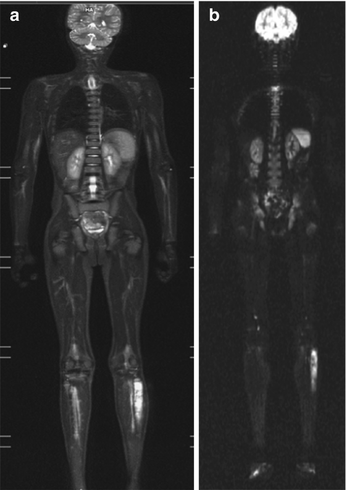 Whole-Body MRI in Pediatric Oncology | SpringerLink