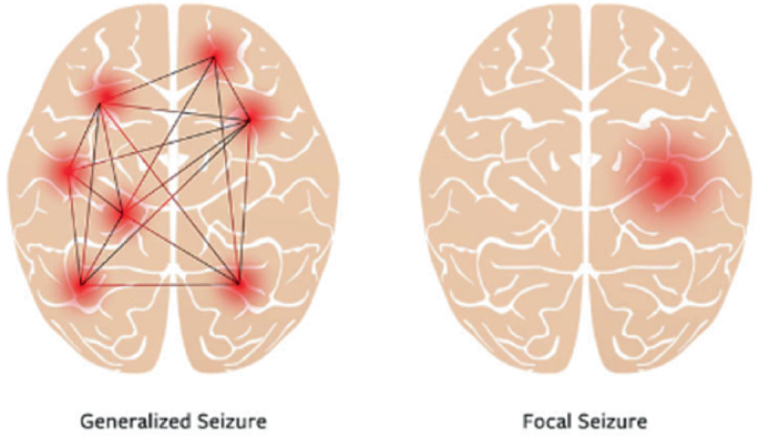 The Classification of Seizures: Distinguishing Focal from Non-focal ...
