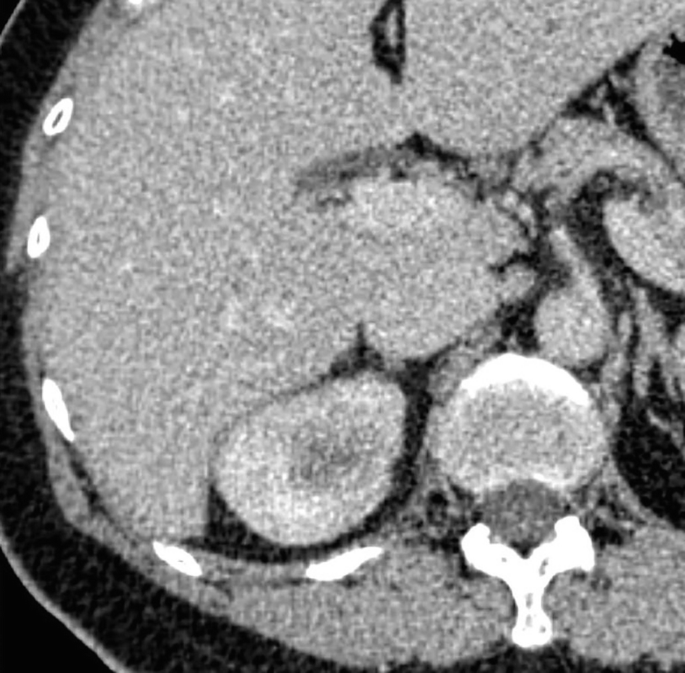 Kidney Surgery: Case 17 Laparoscopic Retroperitoneal Partial ...