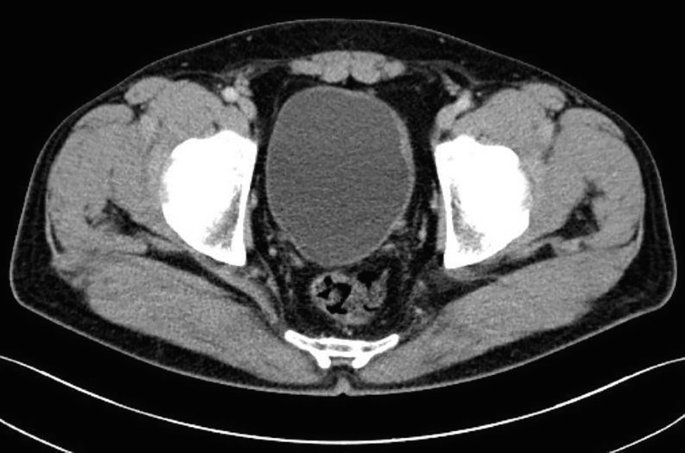 Bladder Surgery: Case 26 Laparoscopic Total Cystectomy | Springer ...