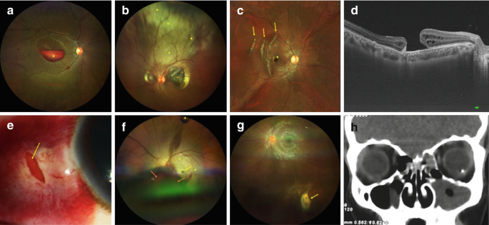 Retina and Vitreous | SpringerLink
