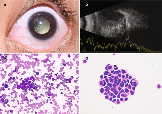 Pathology of Intraocular Tumors | Springer Nature Link