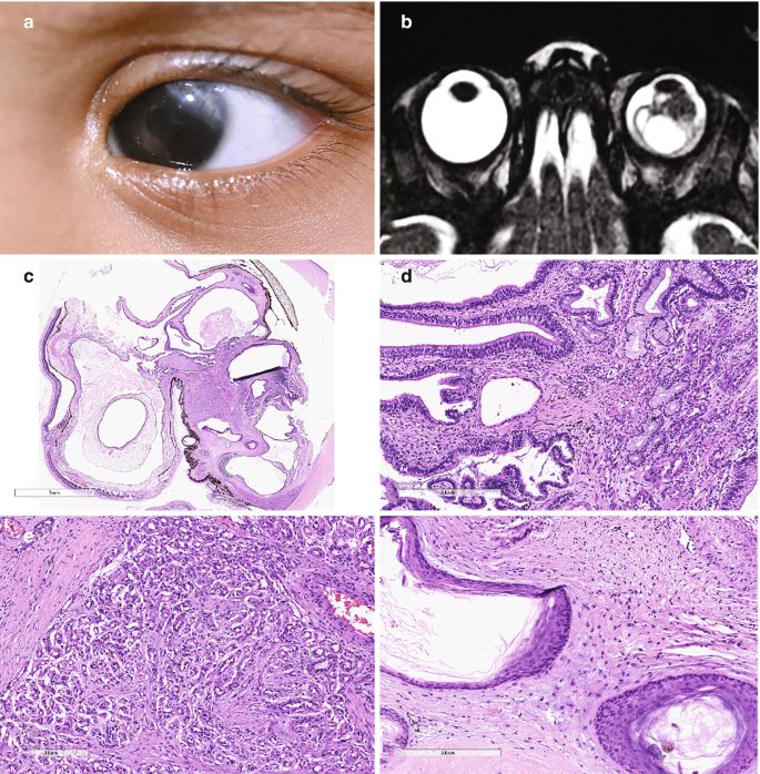 Pathology of Intraocular Tumors | Springer Nature Link