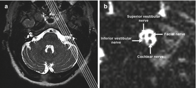 Surgical Perspective of Cochlear Implants: Preoperative Preparation ...