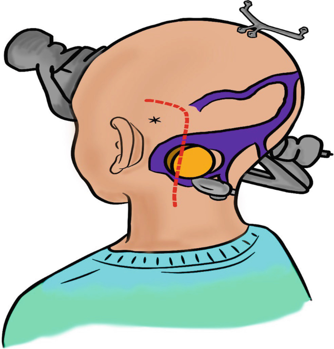 Auditory Midbrain Implants | SpringerLink