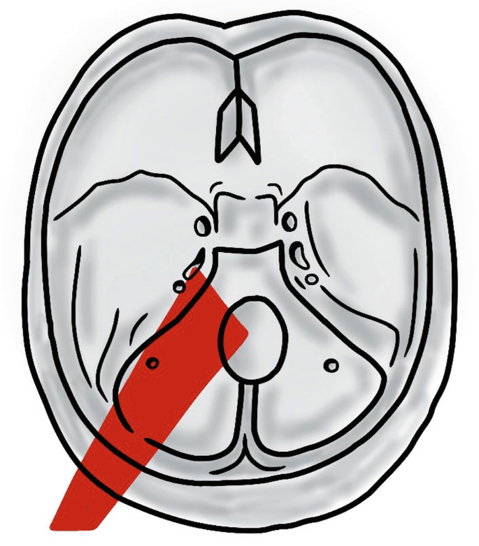 Auditory Midbrain Implants | SpringerLink