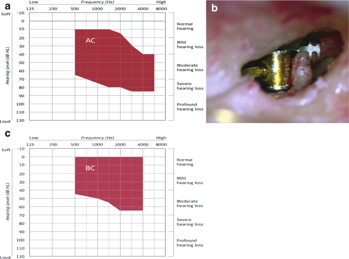 Middle Ear Implants: Surgical Perspectives | Springer Nature Link