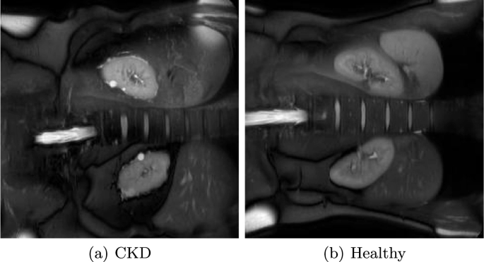 Kidney MRI Classification Using Deep Learning | Springer Nature Link (formerly SpringerLink)