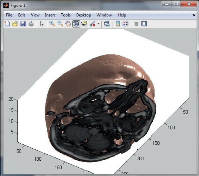 3D Brain MRI Reconstruction: Exploring Axial, Coronal, and Sagittal ...