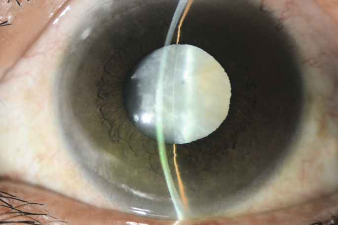 Lens-Induced Glaucoma | Springer Nature Link
