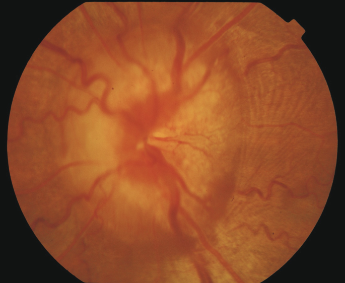 Neuro-Ophthalmology: Bilateral Disc Swelling | Springer Nature Link ...