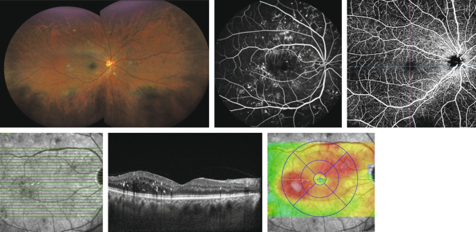 Diabetic Retinopathy | SpringerLink