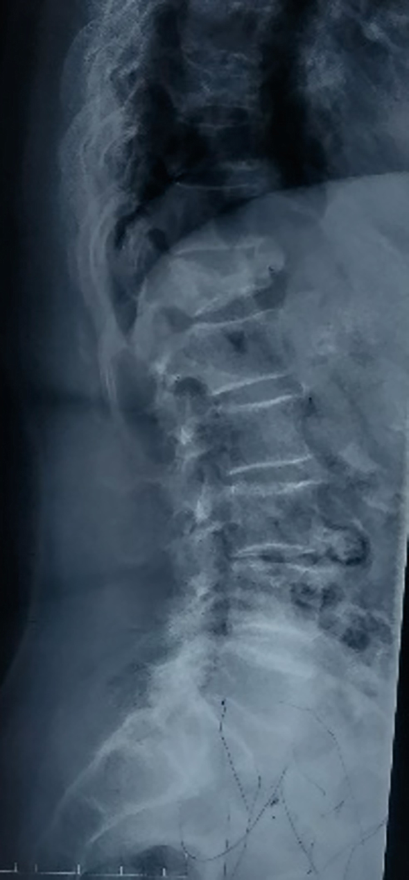 Osteoporosis and Vertebral Compression Fracture | Springer Nature Link