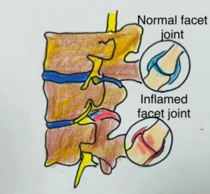 Degenerative Spine Disease and Role of Pain Medicine | Springer Nature Link