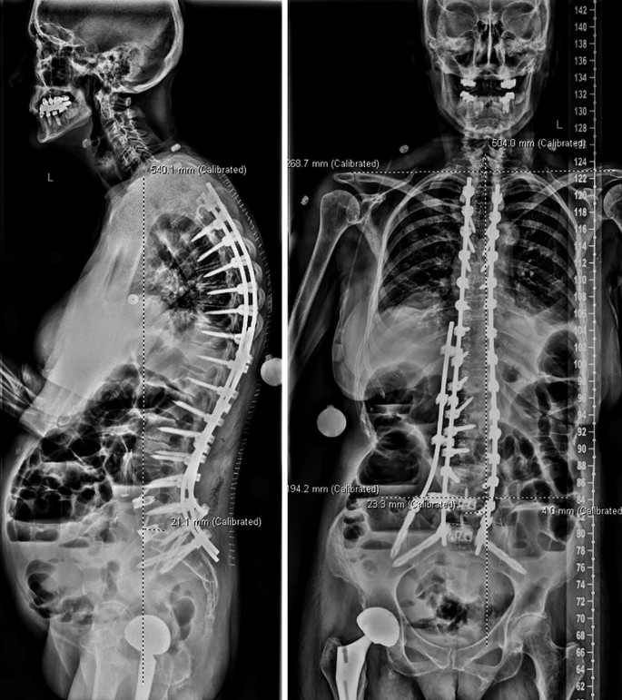 Degenerative Kyphosis and Scoliosis | SpringerLink