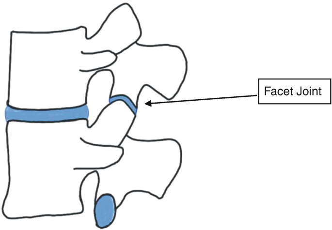 Facet Joint Arthritis: Degeneration of Spinal Joints | SpringerLink