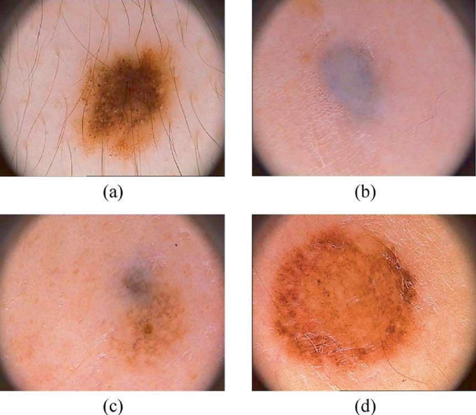 Segmentation of Dermatoscopic Images Using Wavelet Transform | Springer ...