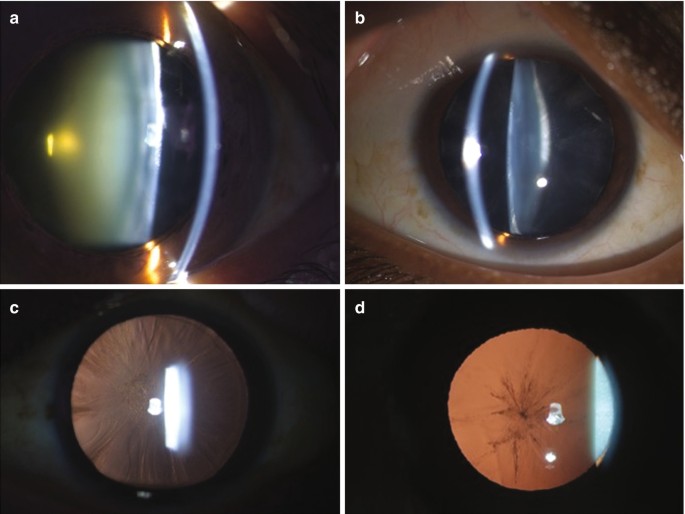 Cataract Grading Systems | SpringerLink
