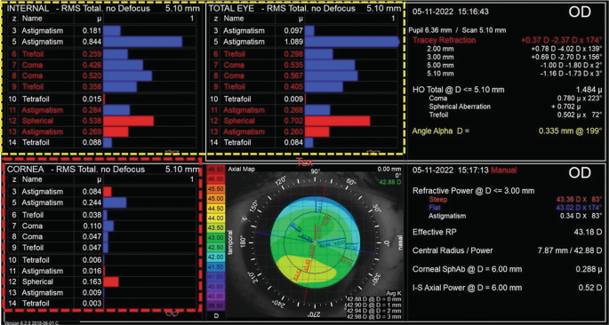 Imaging in Cataract | SpringerLink