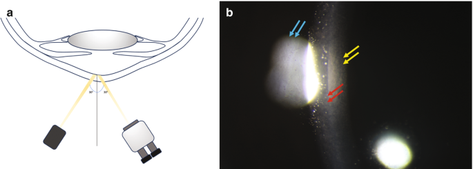 Slit Lamp Biomicroscopy | SpringerLink