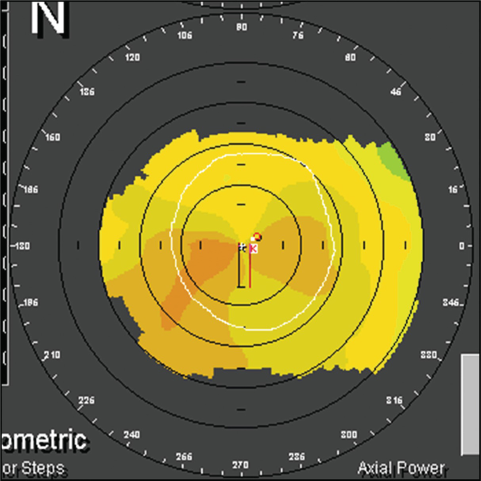 Corneal Topography | SpringerLink