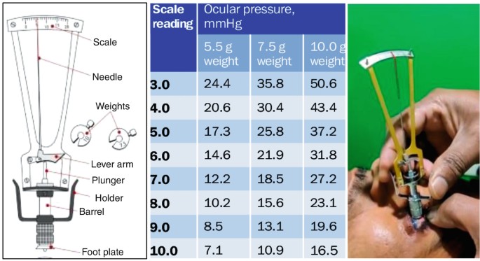 Intraocular Pressure | SpringerLink