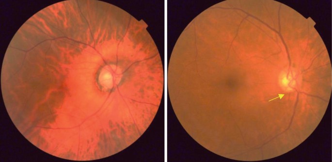Optic Disc Photography | SpringerLink