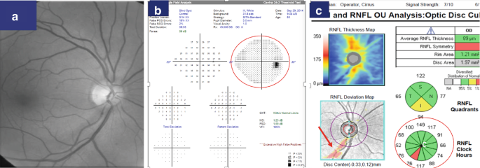 OCT in Glaucoma | SpringerLink