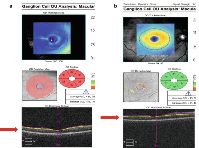 OCT in Glaucoma | SpringerLink