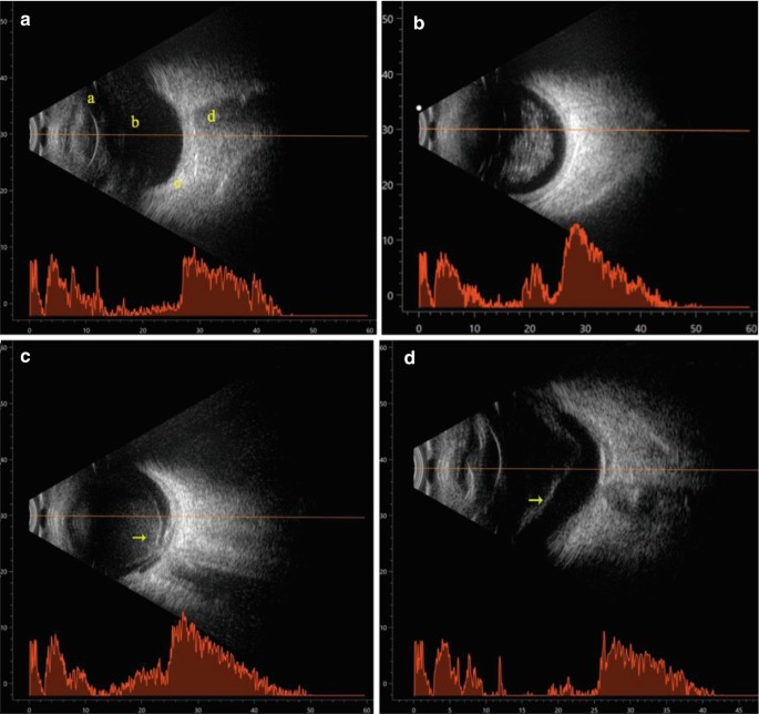 Ophthalmic Ultrasound | SpringerLink