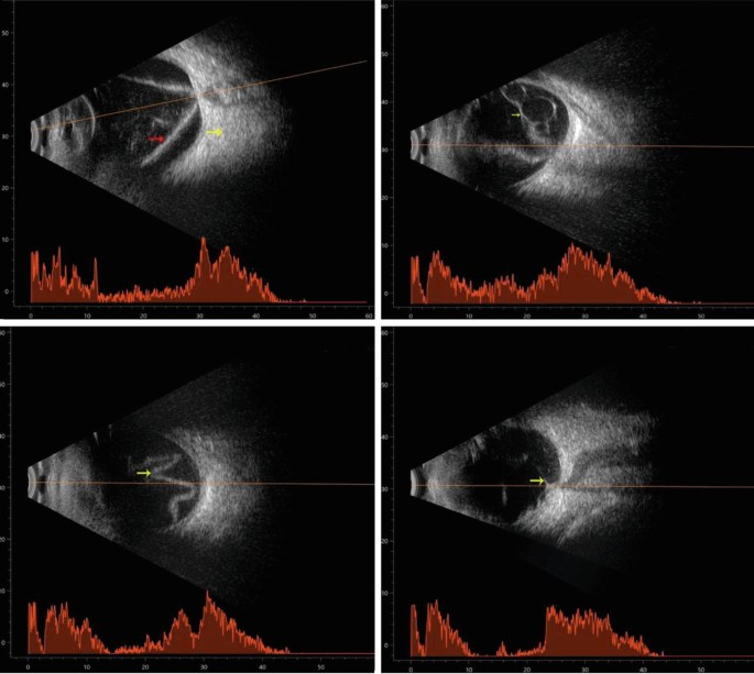 Ophthalmic Ultrasound | SpringerLink