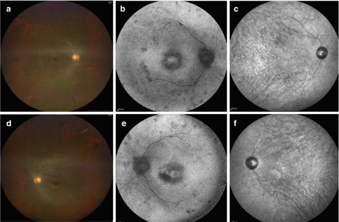 Fundus Photography | SpringerLink