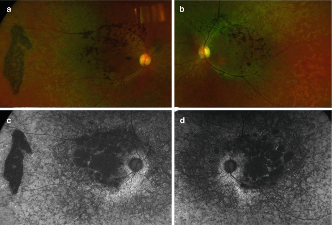 Fundus Photography | SpringerLink