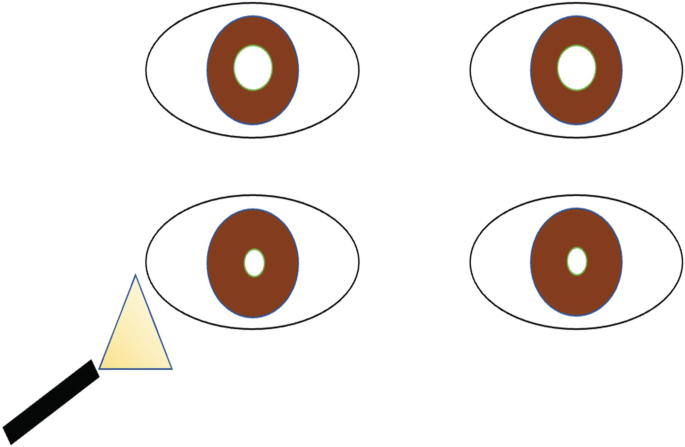The Pupil and Pupillary Reflexes | SpringerLink
